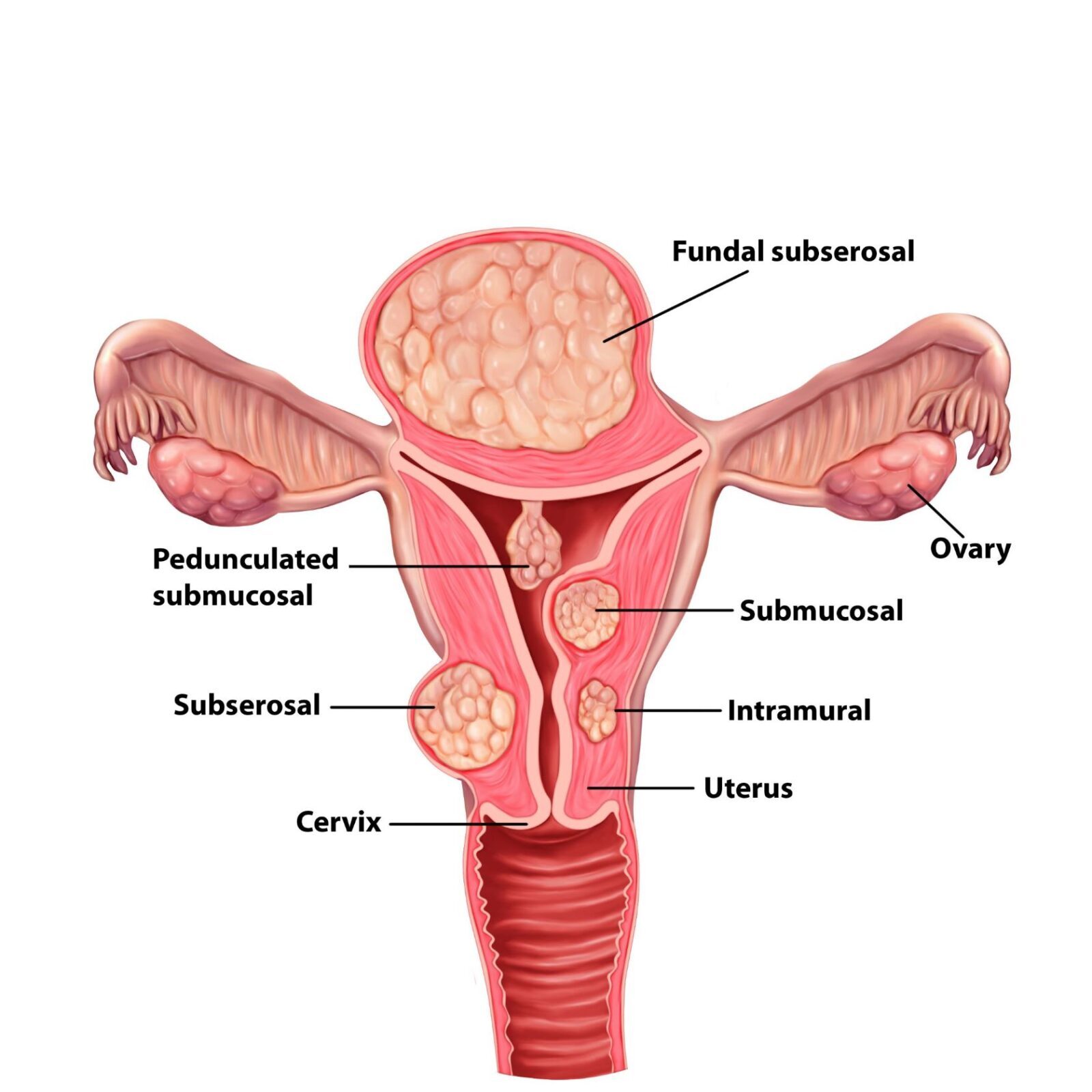 Fundal Subserosal Uterine Fibroids: Causes, Symptoms, Diagnosis, and ...